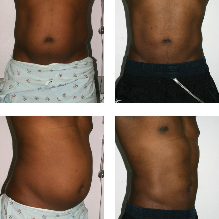 Liposuction process explained by the best cosmetic surgeon, Dr Sanjay ...