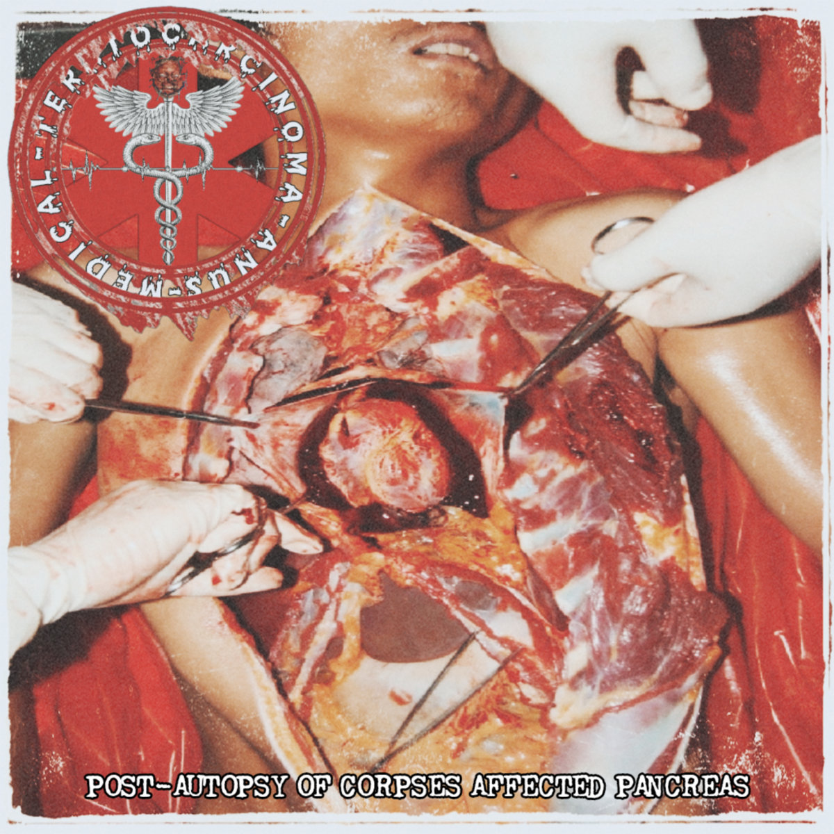 POST-AUTOPSY OF CORPSES AFFECTED PANCREAS | Medicalteratocarcinomaanus