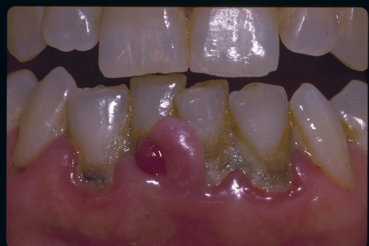 Alveolitis Humeda Dental Tratamiento Pdf Free | Premyfreds | plasindihinre