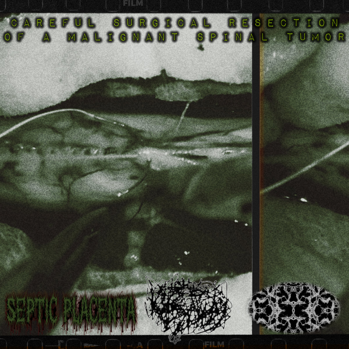 "Careful Surgical Resection Of A Malignant Spinal Tumor" 3 Way Split ...