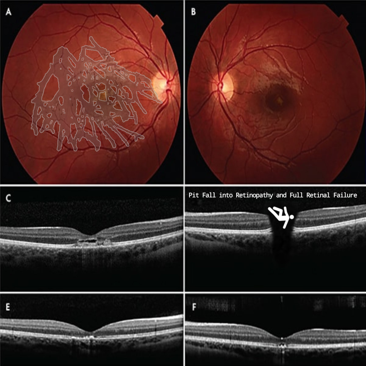 Pit Fall into Retinopathy and Full Retinal Failure | Optical Laceration