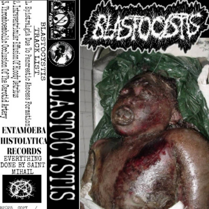 Gangrenosum Epidermis Destroying The Inside Ofthe Skin | Blastocystis ...