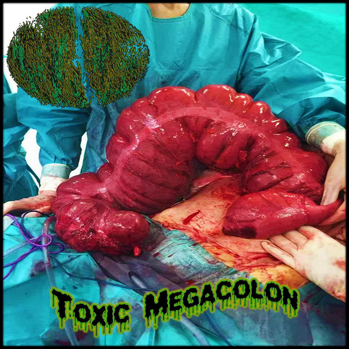Toxic Megacolon | Estenosis Aortica | Javert Nihil