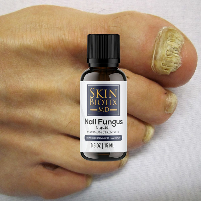 SkinBiotix Nail Fungus Remover (TRUTH EXPOSED!) Concerns Or Does It ...