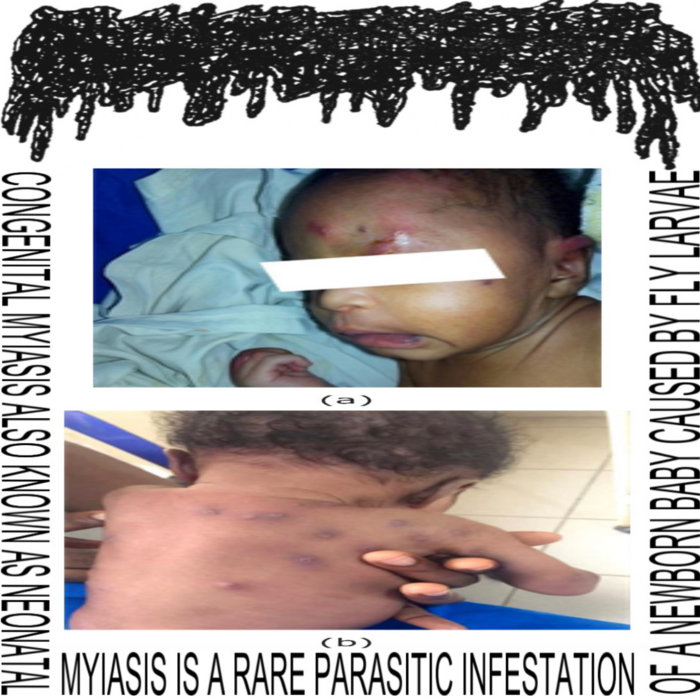 Cases Of Myiasis | Skin Embolization | Back Alley Vomit