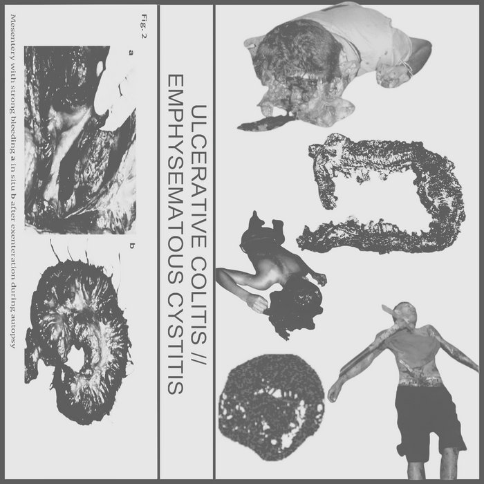 Ulcerative Colitis Medications