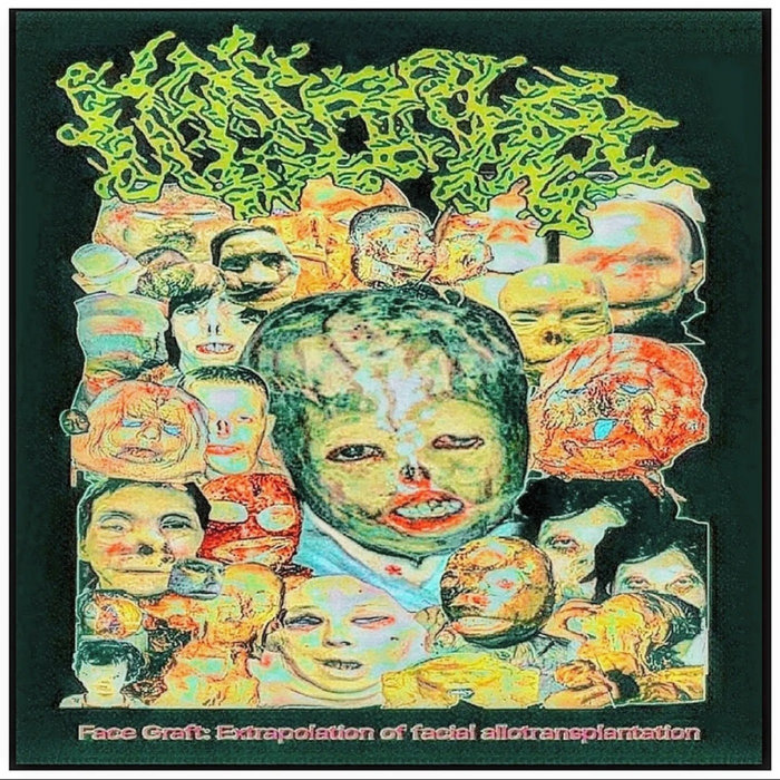 Face Graft: Extrapolation of Facial Allotransplantation | Putrefied