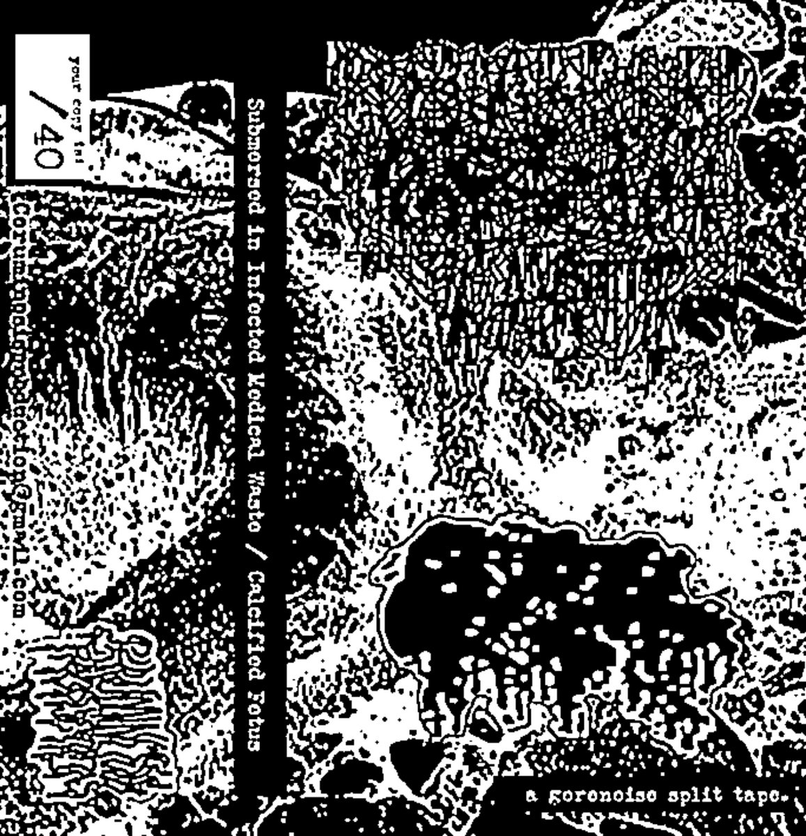 Split with Submersed in Infected Medical Waste | Calcified Fetus