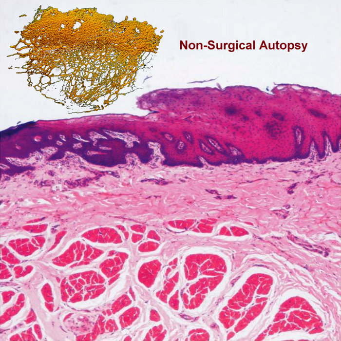 Non-Surgical Autopsy | Anthropophagical Fungus