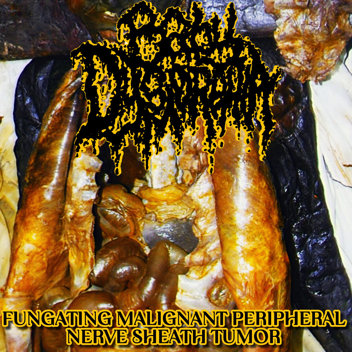 Fungating Malignant Peripheral Nerve Sheath Tumor | Baby Dysmorphia
