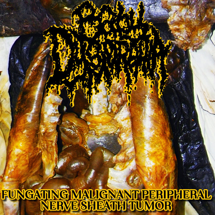 Fungating Malignant Peripheral Nerve Sheath Tumor | Baby Dysmorphia
