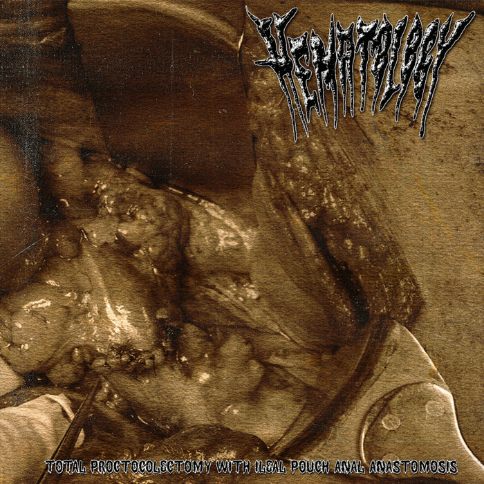 Total Proctocolectomy With Ileal Pouch Anal Anastomosis | Hematology