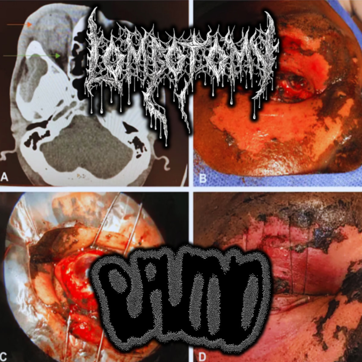 Split W/Puruloid | Lombotomy, Puruloid | LOMBOTOMY
