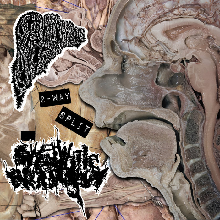 Split W/ Gangrenous Necrosis | Syphilitic Brain Rot