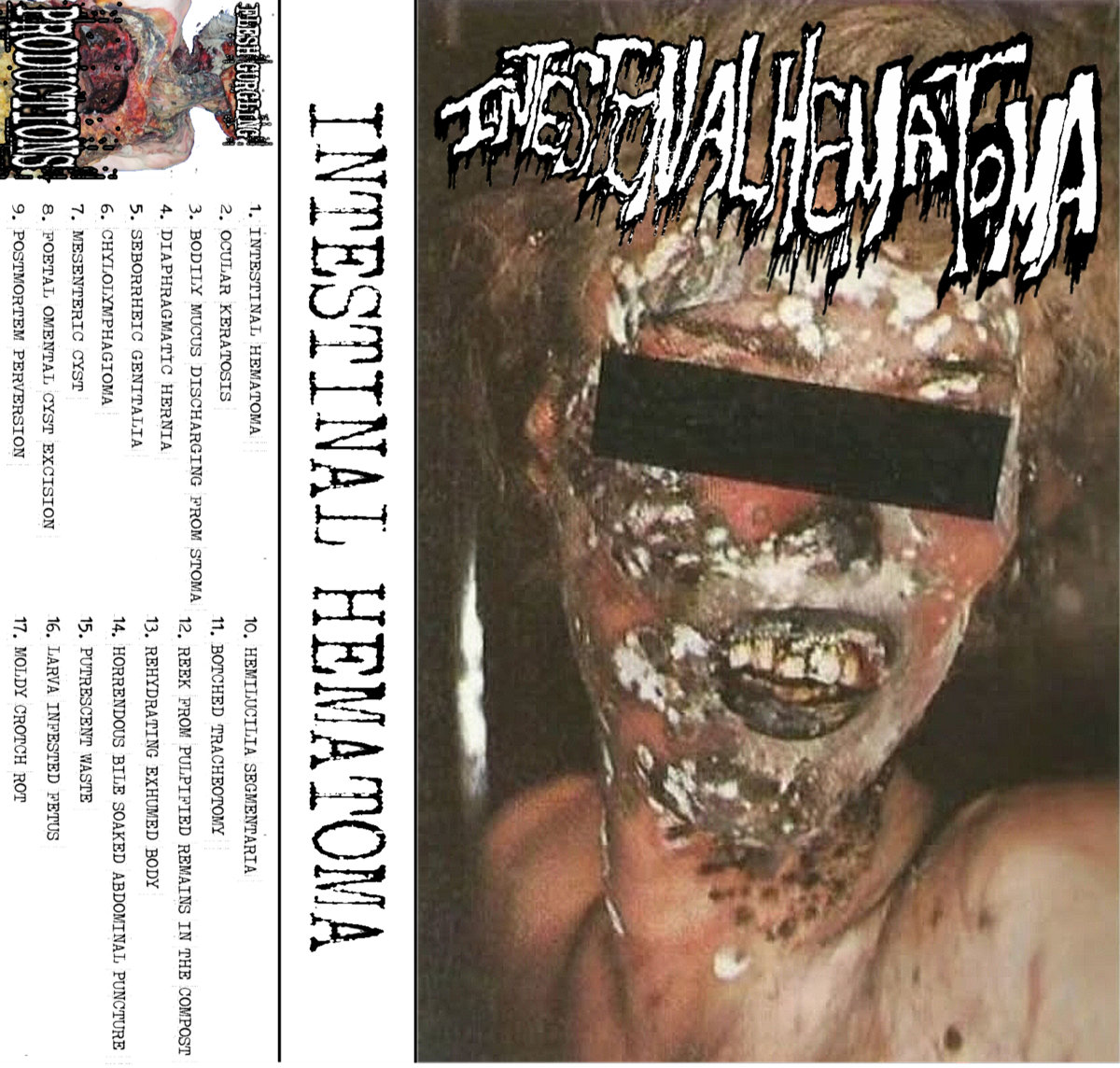 MESENTERIC CYST | INTESTINAL HEMATOMA | Intestinal Hematoma