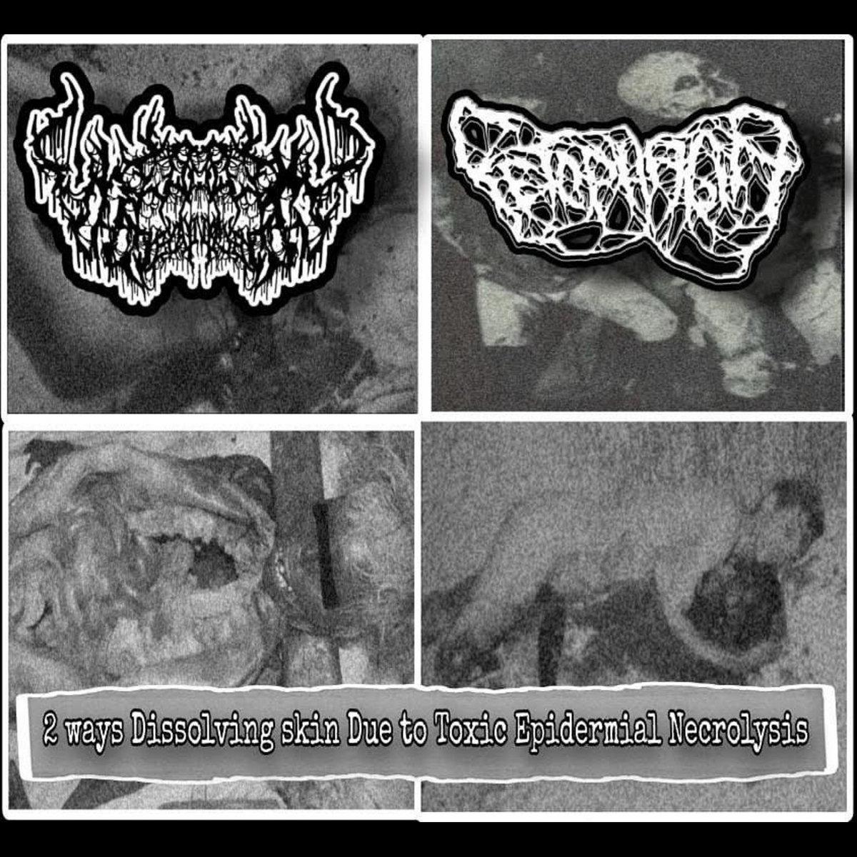2 Ways Dissolving Skin Due To Toxic Epidermal Necrolysis | Vile Flesh ...