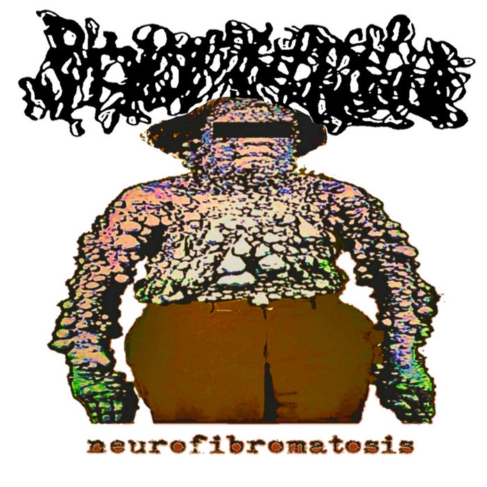 Neurofibromatosis | Putrefied