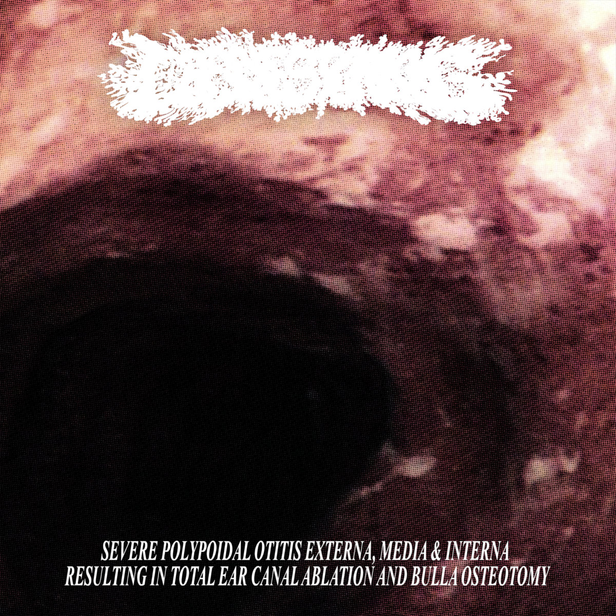Severe Polypoidal Otitis Externa, Media & Interna Resulting In Total ...