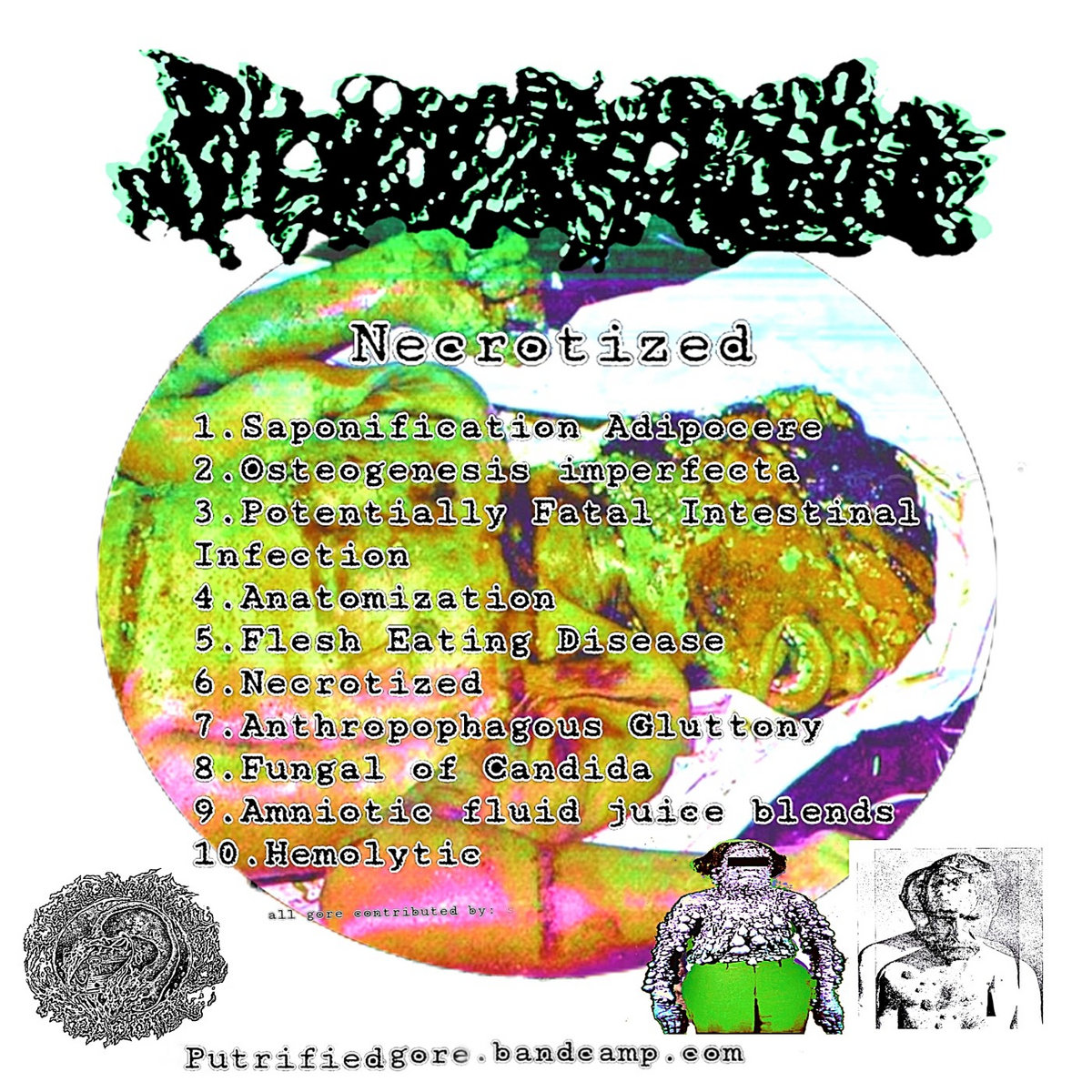 1.Saponification Adipocere 2.Osteogenesis imperfecta 3.Potentially ...