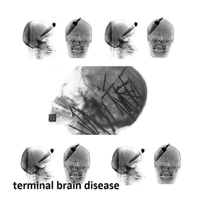 Terminal Brain Disease | tbd | Killer Tofu Records