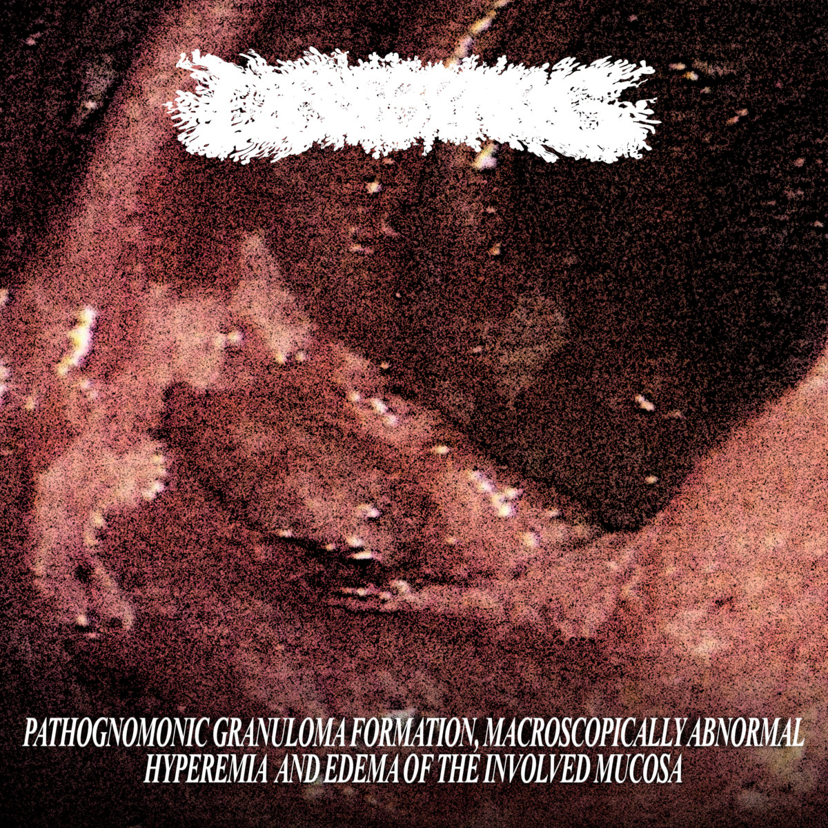 Pathognomonic Granuloma Formation, Macroscopically Abnormal Hyperemia ...