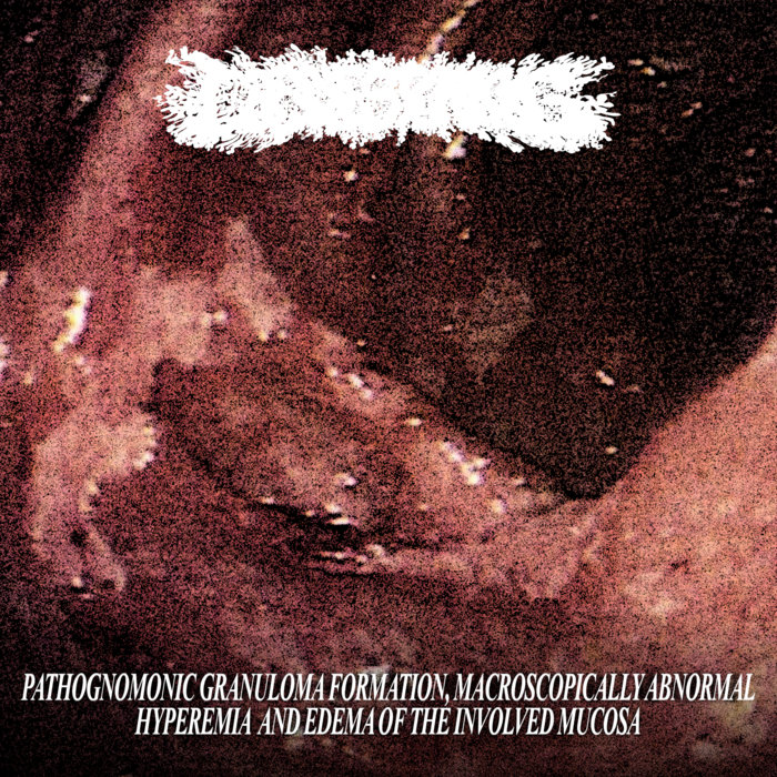Pathognomonic Granuloma Formation, Macroscopically Abnormal Hyperemia ...