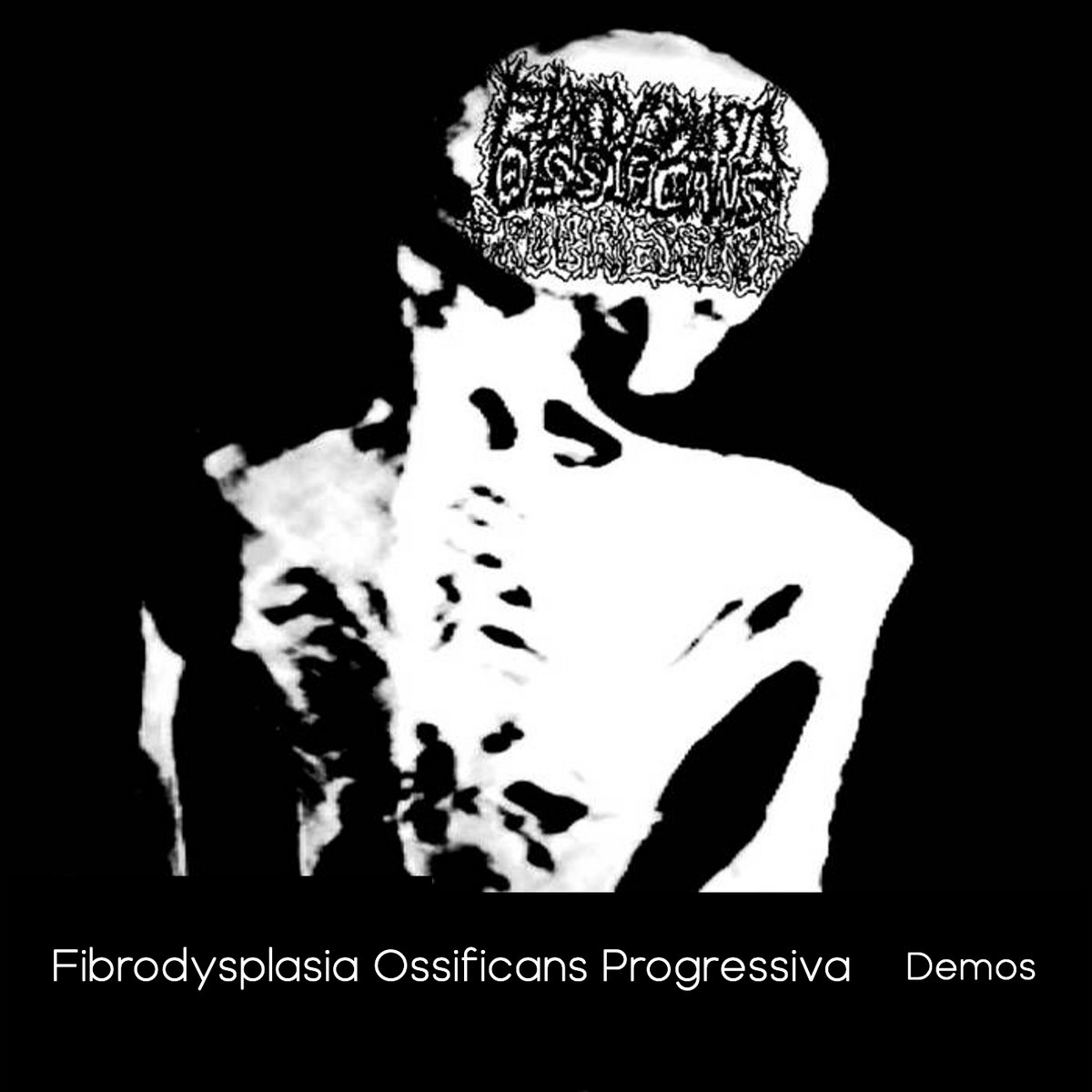 Fibrodysplasia Ossificans Progressiva - Demos (aNr110) | Fibrodysplasia ...