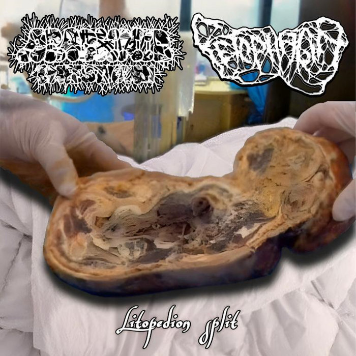Fetophagia x Arachnid Infestation Split - " Litopedion split ...