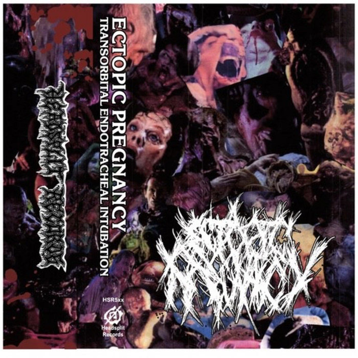 Transorbital Endotracheal Intubation | Ectopic Pregnancy