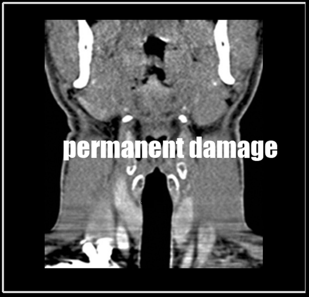 permanent damage | 1 2