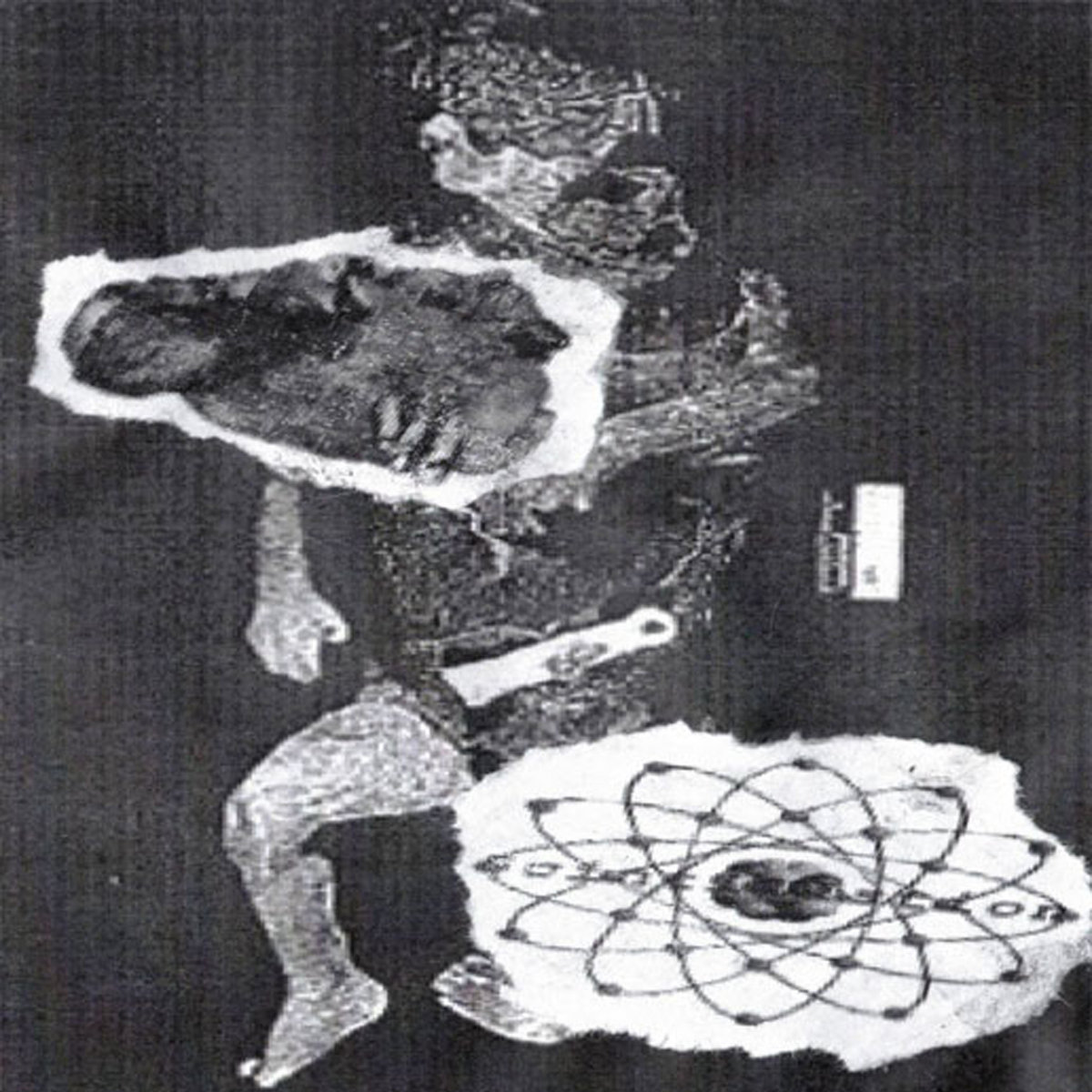 Congenital Malformation With Internal Bodily Decay From Severe ...