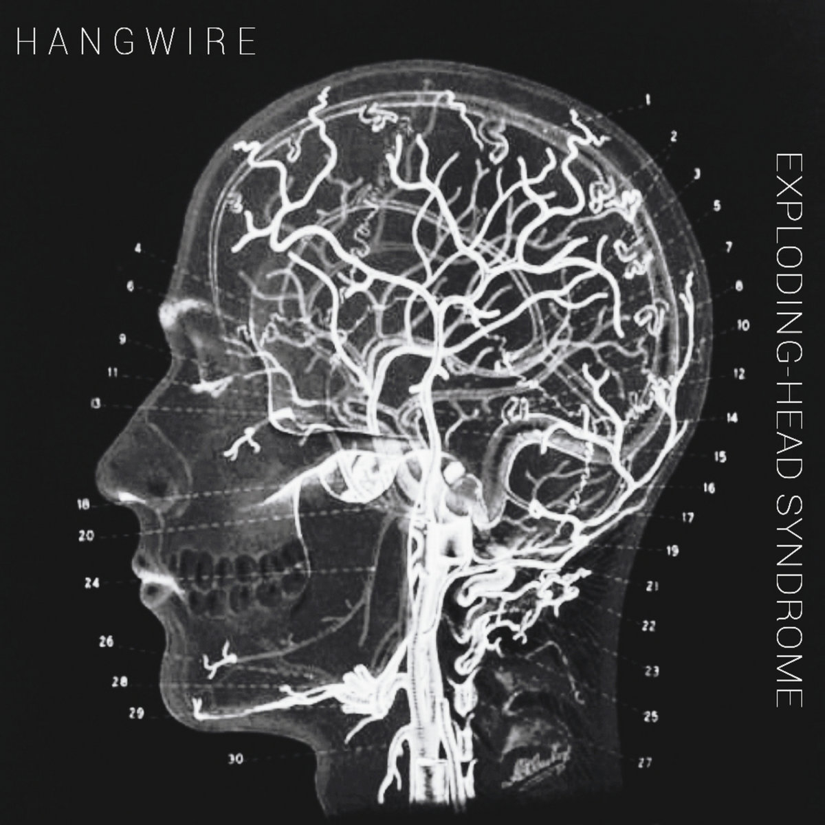 Exploding-Head Syndrome | Hangwire