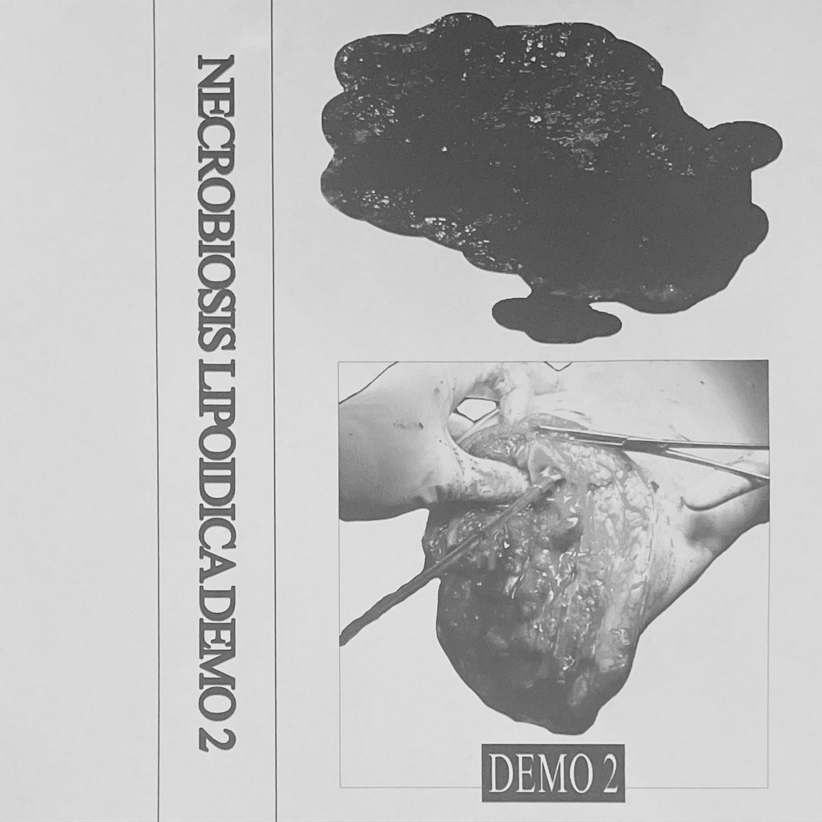 Demo 2 | Necrobiosis Lipoidica