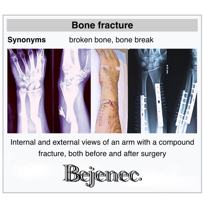 Bone Fracture | Bejenec