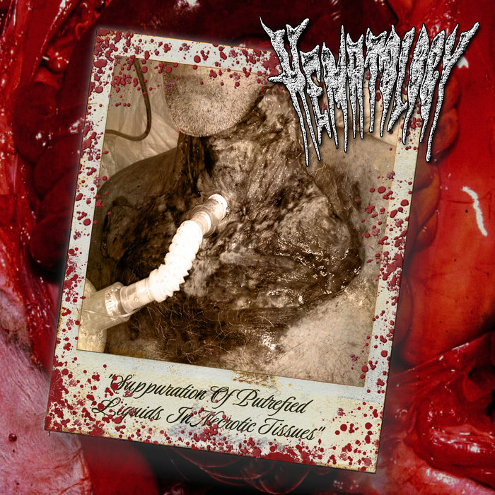 Suppuration Of Putrefied Liquids In Necrotic Tissues | Hematology