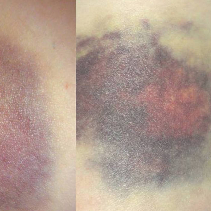 Split with Dosis Letalis | Bruising Pattern
