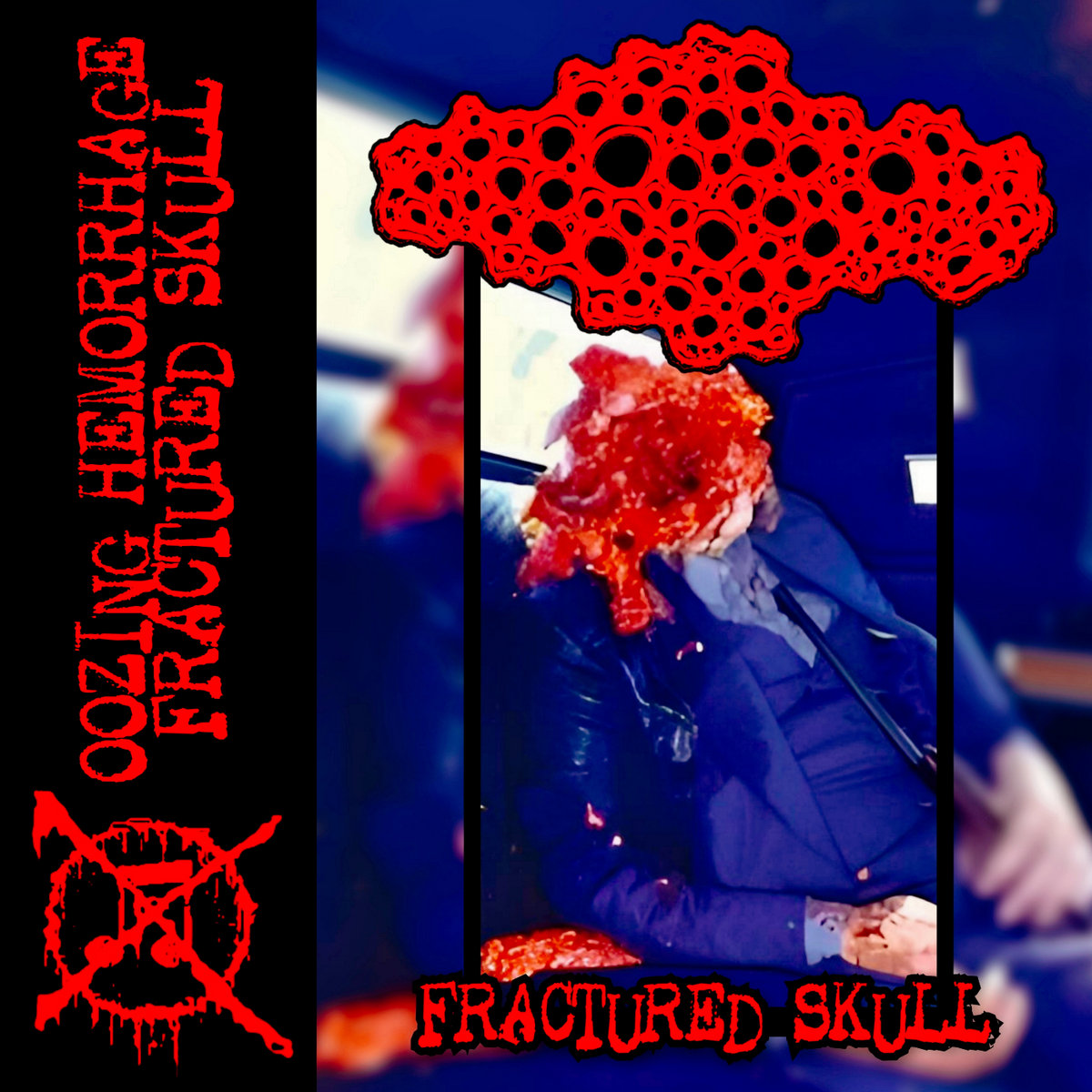 Fractured Skull | Oozing Hemorrhage | Jaxon Pusgrind