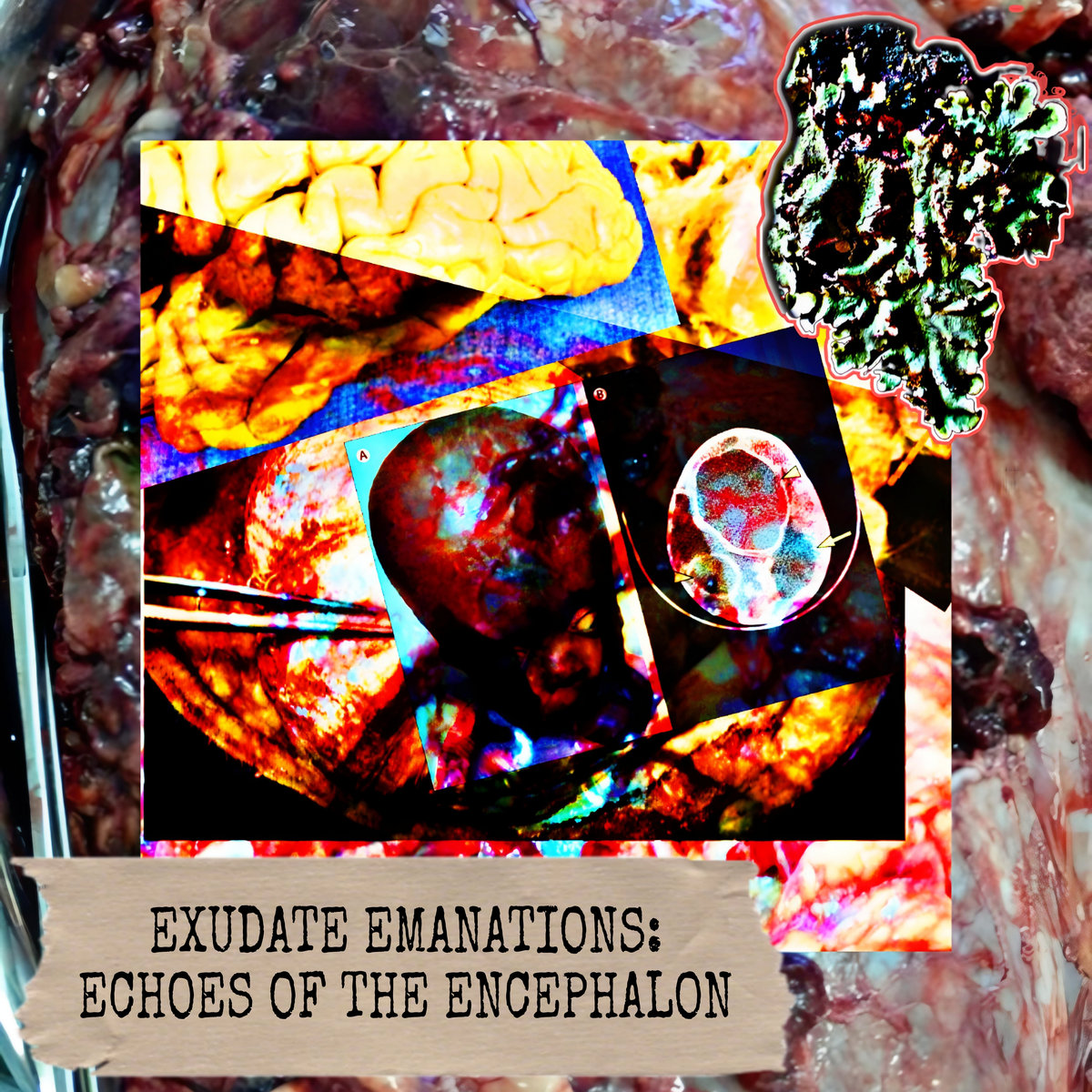EXUDATE EMANATIONS: ECHOES OF THE ENCEPHALON | PUTRID PIA MATER PURGE ...