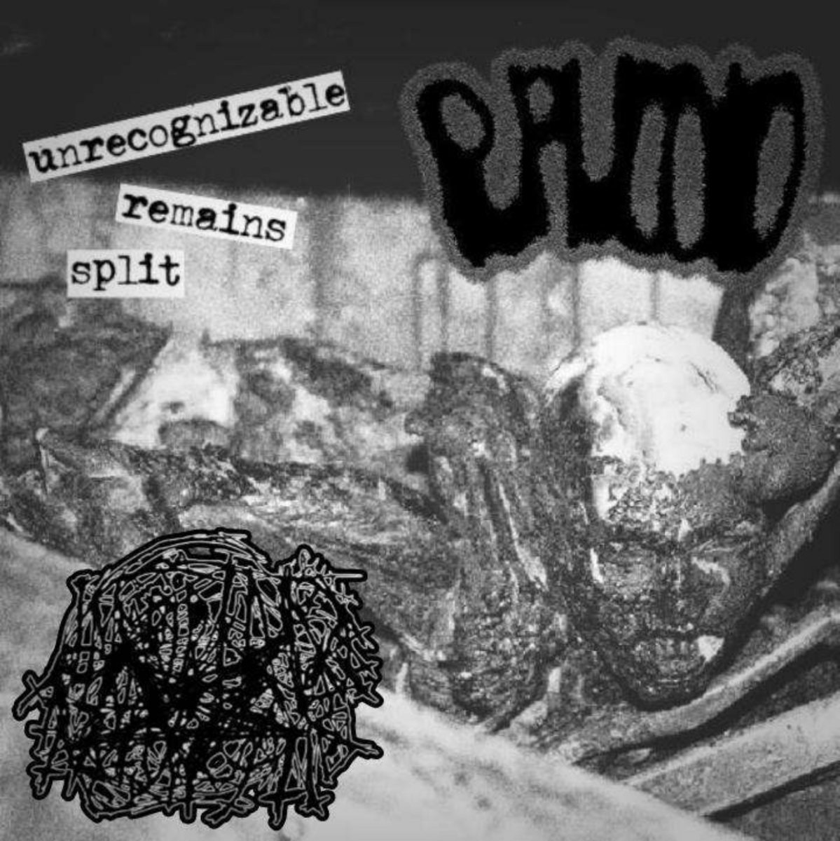 (Puruloid) Sarcoidosis Causing Inflamed Lymph Nodes | Puruloid ...