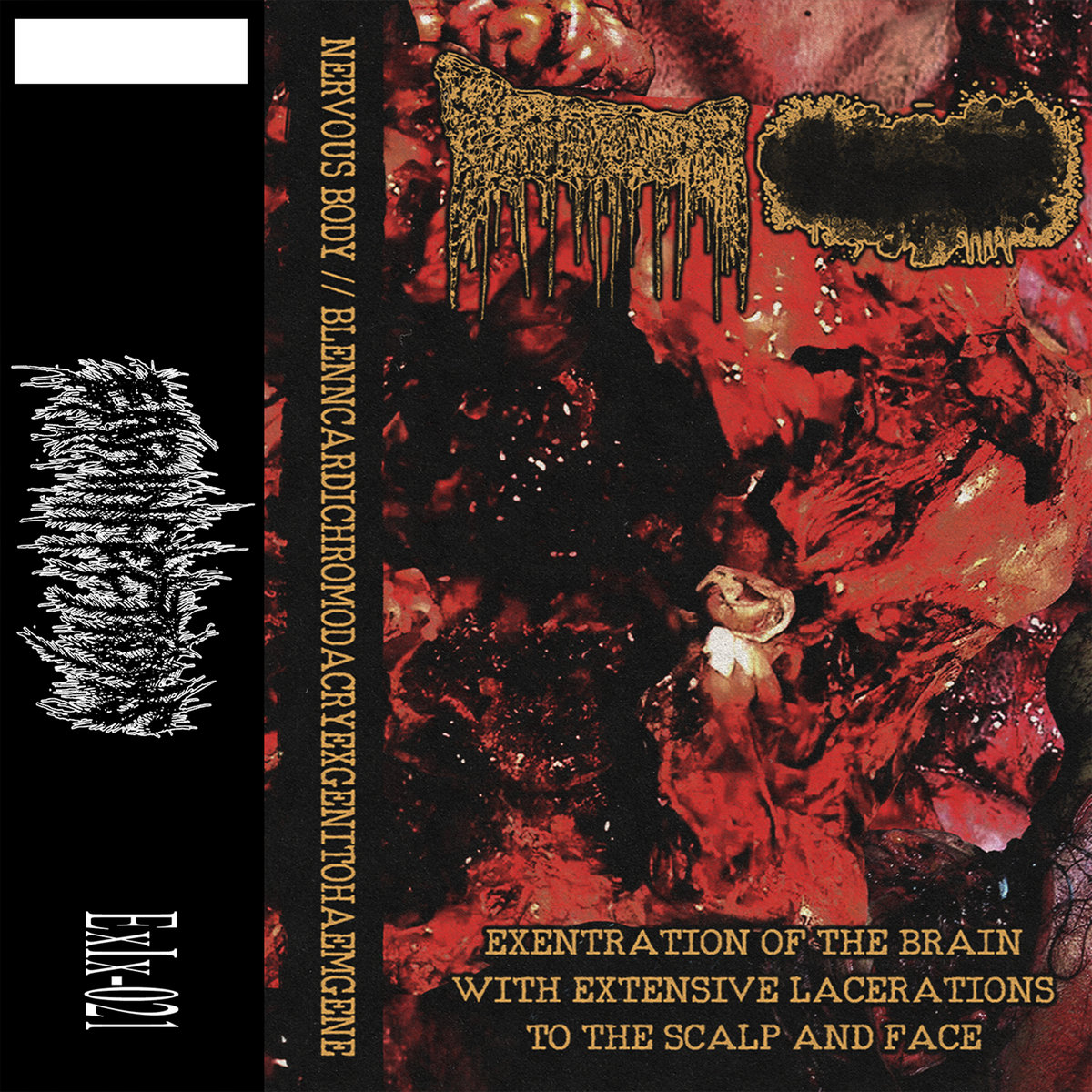 Exenteration of The Brain With Extensive Lacerations to the Scalp and ...