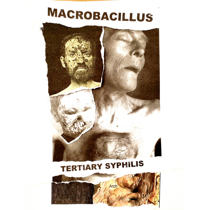 Tertiary Syphilis | Macrobacillus | Bacillus