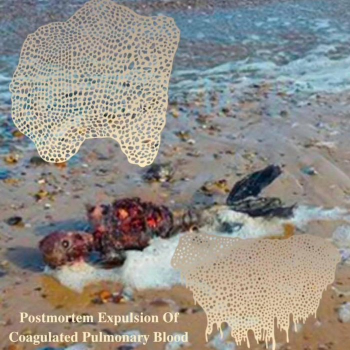 Postmortem Expulsion Of Coagulated Pulmonary Blood (Split With Myeloma ...