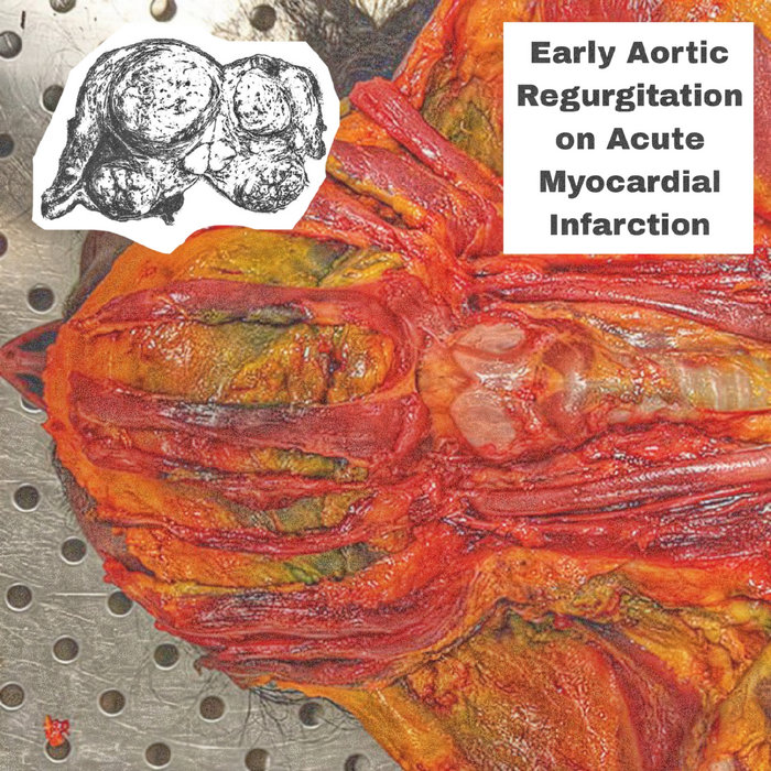ULCERATING TUMOR - EARLY AORTIC REGURGITATION ON ACUTE MYOCARDIAL ...