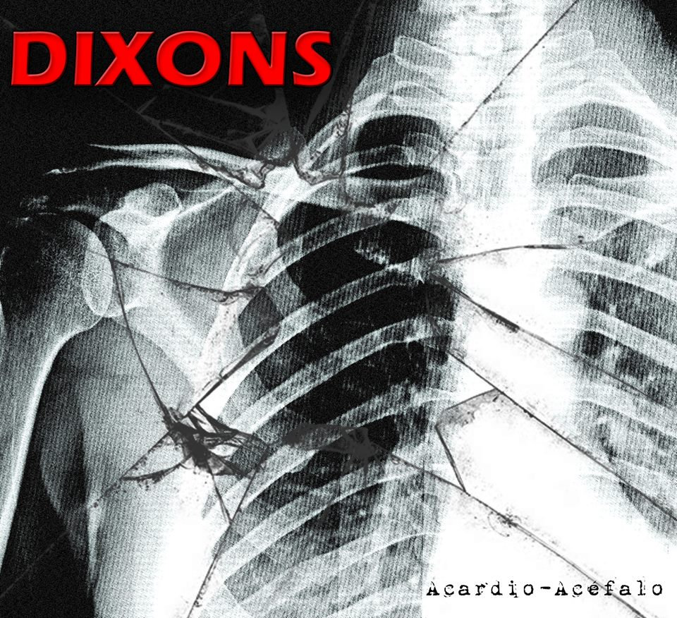 Acardio / Acéfalo | Dixons