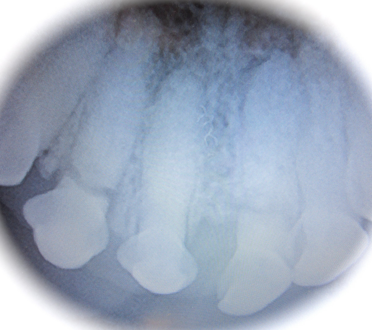 One Pushed Back Tooth Cracked | Amawak | spareswairatpa