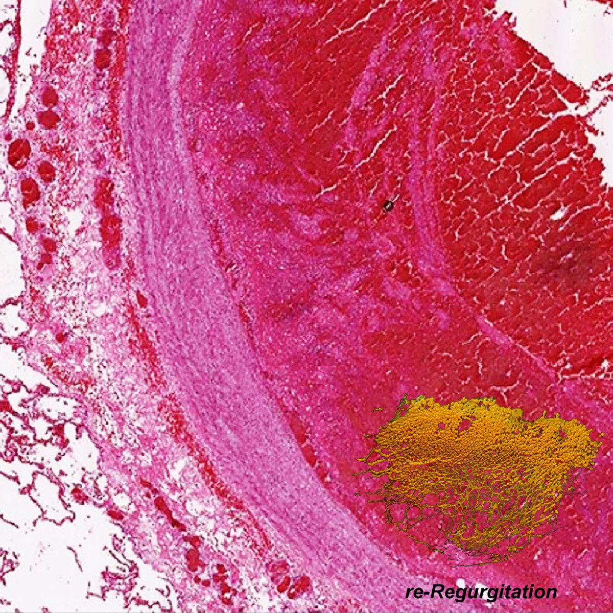 Precoital Phalangeal Lividity | Anthropophagical Fungus