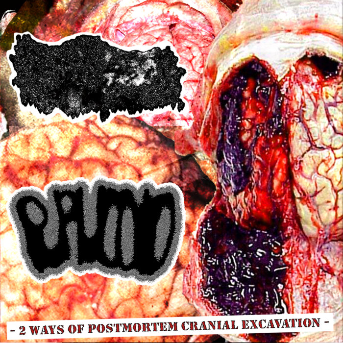2 Ways of Postmortem Cranial Excavation - Split W/ Puruloid ...
