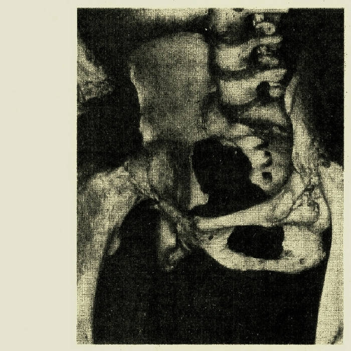 Joseph Merrick As A Child