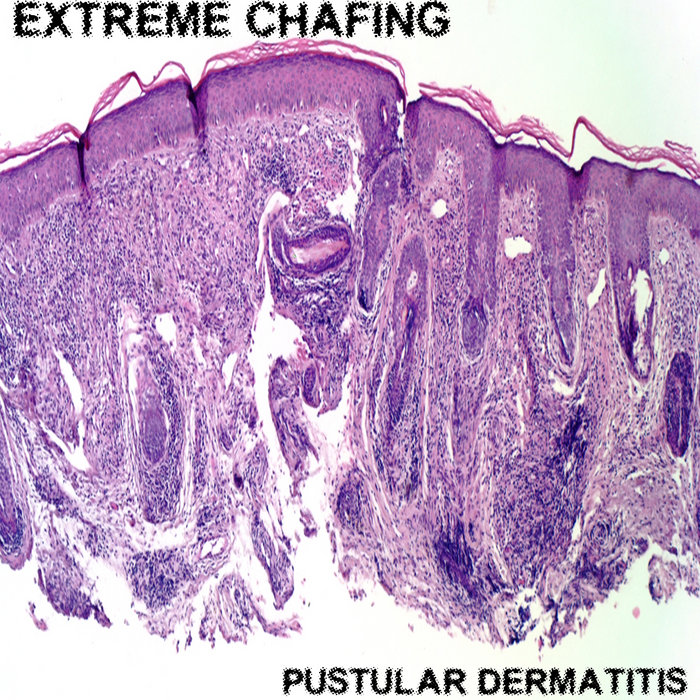Pustular Dermatitis | Extreme Chafing