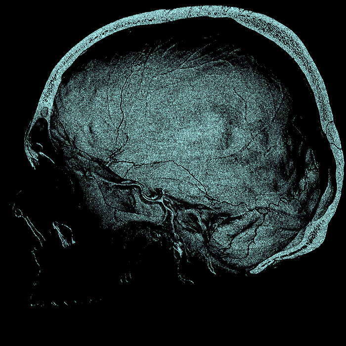 CAVEMAN CRANIECTOMY | the Man From Another Place